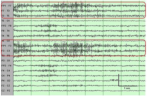 Strategies To Reduce Eegqeeg Artifacts