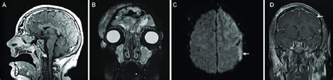 Preoperative Mri At The Time Of Presentation Sagittal T1 Weighted