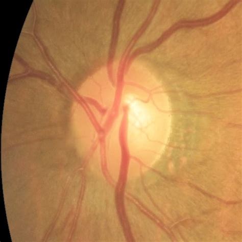 Qualitative Comparison On Partially Supervised Optic Disc And Cup