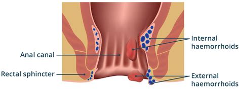 External Hemorrhoids Symptoms Hemorrhoids Symptoms Causes And