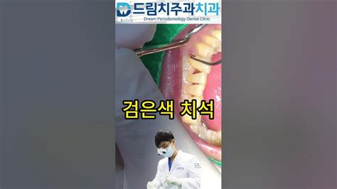 잇몸 속 치석 제거 영상 잇몸에 검은색이 비쳐 보인다면 확인 부산 드림치주과치과 최정혁 원장 Youtube
