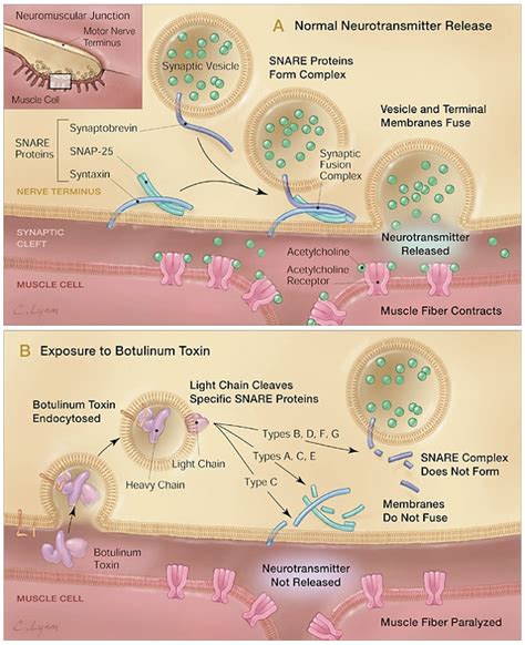 Botulinum Toxins Bad Bug Or Miracle Medicine Inquiries Journal