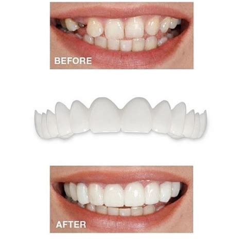 Купить Виниры на зубы Snapon Smile оптом цена оптом от 60 рублей