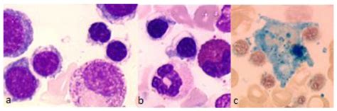Diagnostics Free Full Text When Ring Sideroblasts On Bone Marrow