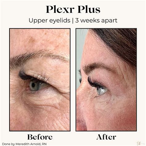 Plexr Plus Upper Total Skin And Body Anti Aging Spa Facebook