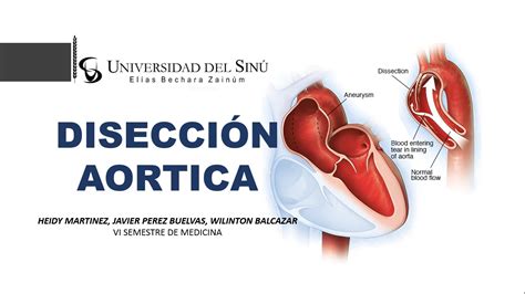Disecci N Aortica Biology Quizizz