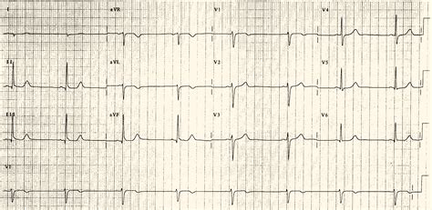 Normal Sinus Rhythm Wikidoc