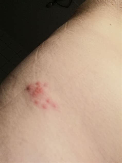 Красное пятно с прищами Вопрос дерматологу 03 Онлайн