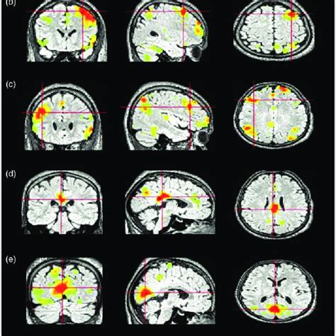 Pdf Resting State Fmri A Review On Methods In Resting State