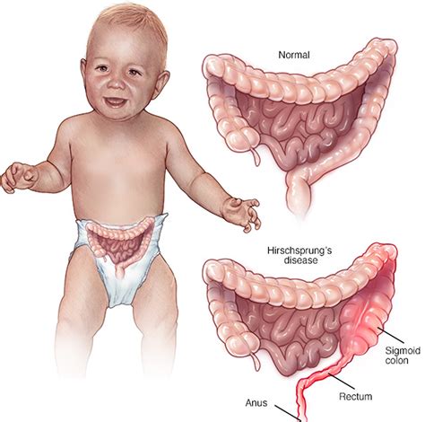 Hirschsprung Disease Causes Signs Symptoms Diet And Treatment