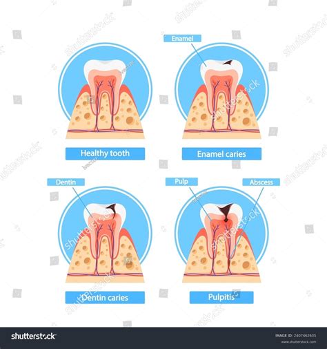 Caries Stages Infographics Healthy Tooth Royalty Free Stock Vector