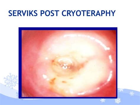 Tata Cara PROSEDUR CRYOTHERAPY Translate Pptx