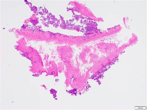 Pathology Outlines Eosinophilic Esophagitis Pathology Of Eosinophilic