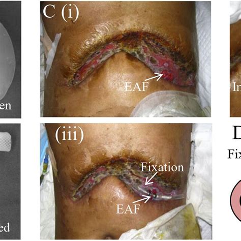 Fistula Patch For The Occulsion Of Eaf A The Appearance Of Fistula