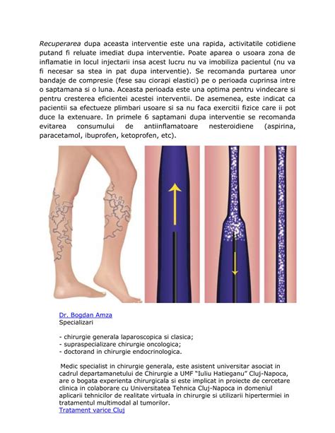 Ce Sunt Varicele Metode De Tratament Ale Varicelor Pdf