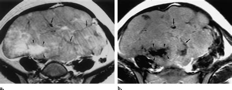 Dysgerminoma In A 17 Year Old Girl A Axial Turbo Spin Echo