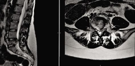 Technical Nuances Of A Posterior Only L5 Vertebrectomy With Anterior Column Reconstruction Pmc