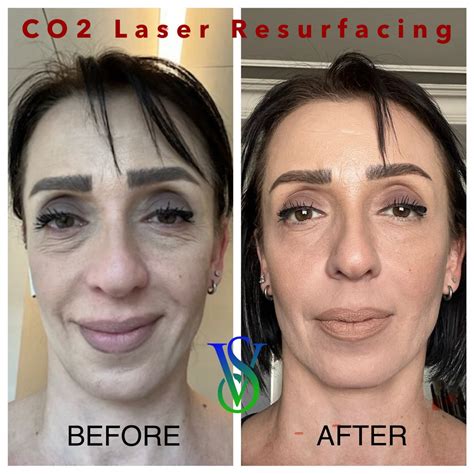 Under Eyes Bags And Dark Circles Co2 Laser Correction In Glendale Ca