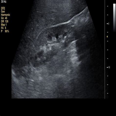 肾结石分类和对象检测数据集 肾结石检测超声图像数据集 含 9416 张原始处理图像 适用于肾结石检测模型训练 医学影像资源 Csdn博客