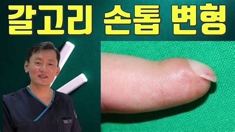 Hook Nail Deformity Correction At Barbara Bowles Blog