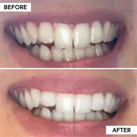 Teeth Whitening Starter Bundle Toothpaste Whitening Strips Icy Bear Dental