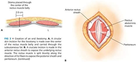 Loop Ileostomy Diagram