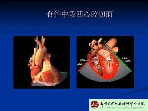 Ppt 经食管超声心动图的临床应用 Transesophageal Echocardiography Tee Powerpoint