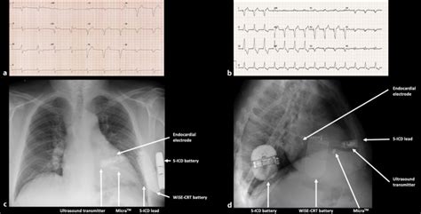 Endocardial Left Ventricular Pacing Abstract Europe PMC