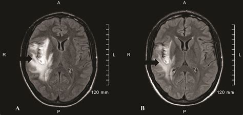 Dual Peak Post Stroke Edema In A Patient With Infective Endocarditis