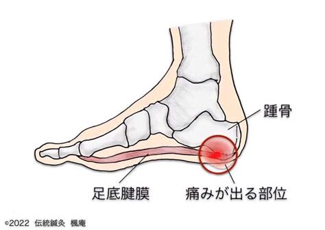 足底腱膜炎・モートン病｜伝統鍼灸 楓庵