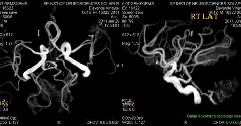Dr Balaji Anvekar Frcr Persistent Trigeminal Artery