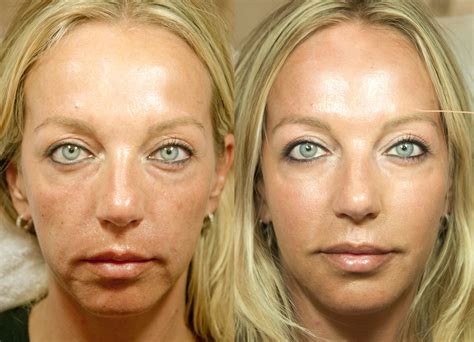 Filler Face Lift Before And After