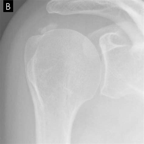Shoulder Calcification