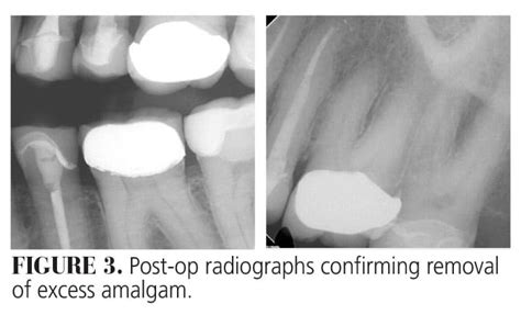 Use Of Laser Therapy In Amalgam Tattoo Removal