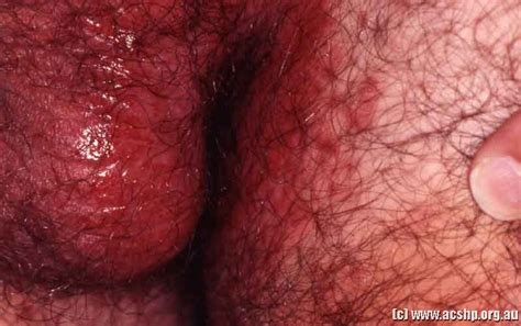 Tinea Groin Red Book Online