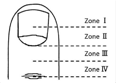 Ishikawa S Classification Of The Amputated Finger Download