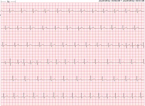 Short Svt Run With Weird Looking Qrss Why Do These Qrss Look Weird