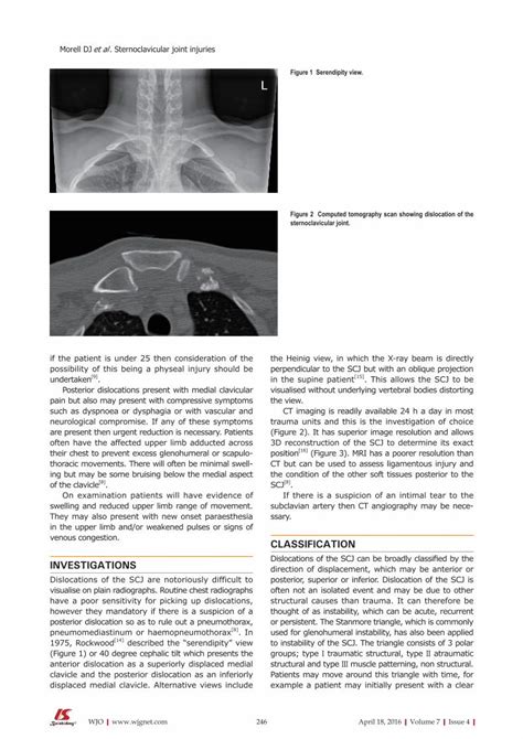 Pdf Sternoclavicular Joint Dislocation And Its Management A