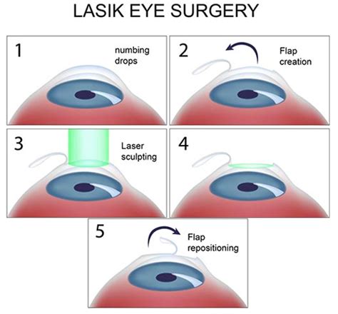 LASIK Eye Surgery For Astigmatism What You Need To Know