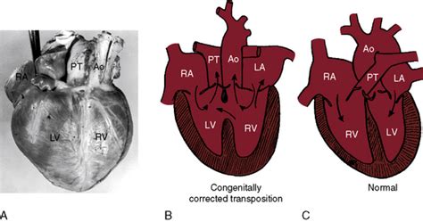 Congenitally Corrected Transposition Of The Great Arteries Thoracic Key