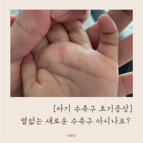아기 수족구 초기증상 열없는 새로운 수족구 아시나요 네이버 블로그