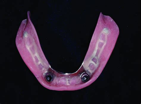 Intaglio Surface Of Mandibular Implant Overdenture Download