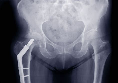 What Are The Most Common Types Of Ankle Fractures Artofit