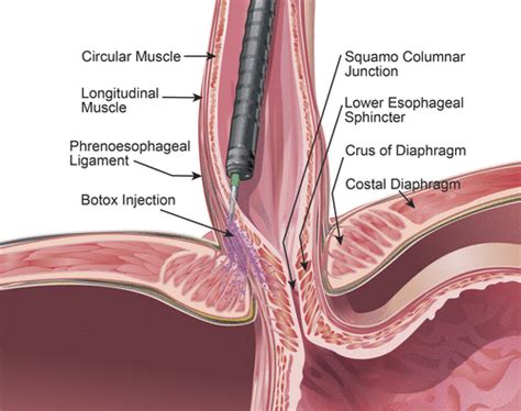 Lower Esophageal Sphincter Anatomy