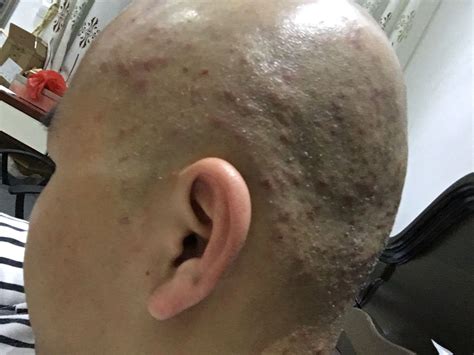 癞子病图片皮肤病癞子症状及图片 伤感说说吧