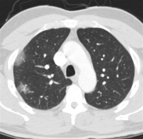 Ground Glass Infiltrates And Opacities Introduction Lungs