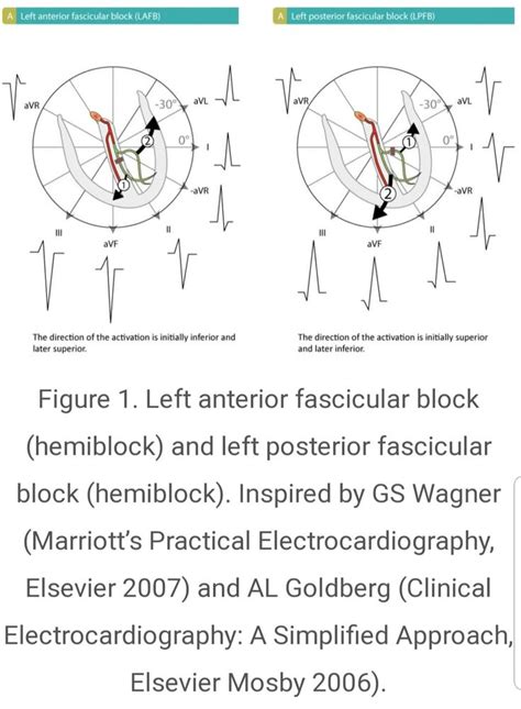 Left Anterior And Left Posterior Fascicular Block Ecg And Echo
