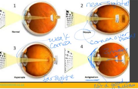 Optometry Flashcards Quizlet