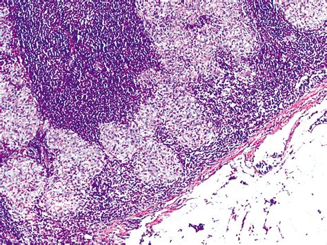 Pathology Outlines Sarcoidosis