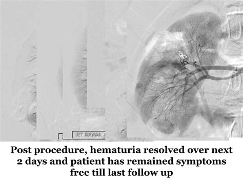 Op3 Renal Avm Mimicking Glomerular Disease Ppt